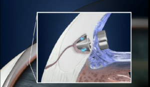Glaucoma Management - Fraser Valley Cataract & Laser