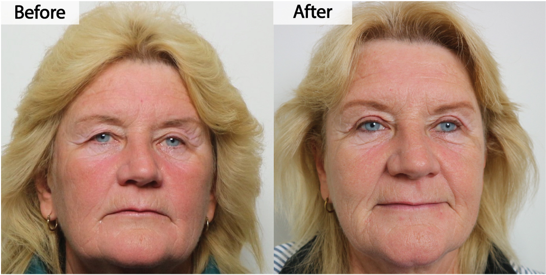 Common Eyelid Issues (and how to fix them) - Fraser Valley Cataract & Laser